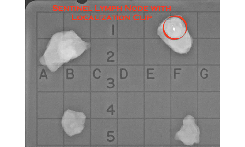 Targeted Axillary Dissection Following Neoadjuvant Chemotherapy ...